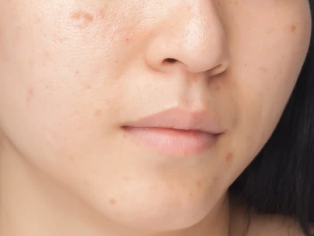 Acne Causes and Treatment [Definitive Guide]