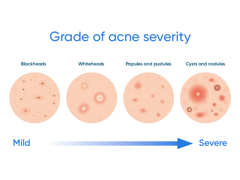 Acne Signs and Symptoms [Definitive Guide]