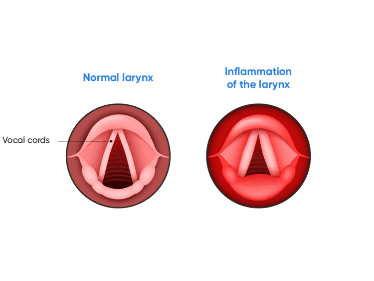 Laryngitis Symptoms (Plus Treatment) - Definitive Guide