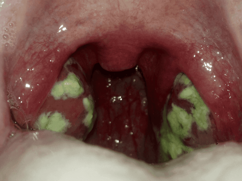 Tonsillitis Symptoms (Plus Treatment) - Definitive Guide
