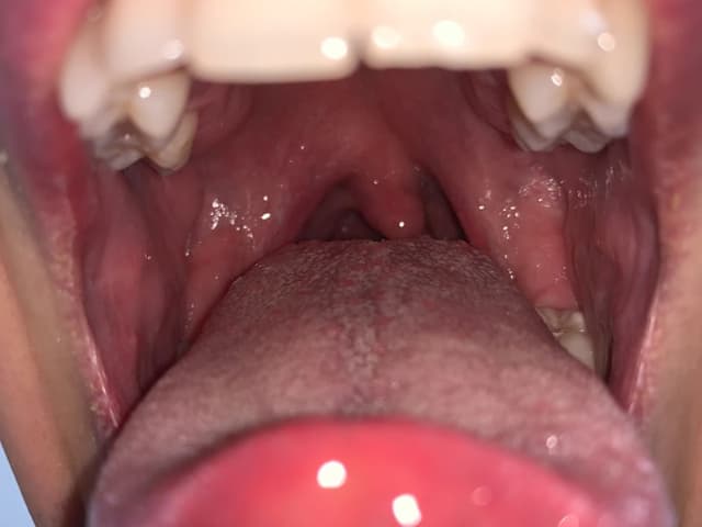 Tonsillitis Symptoms Plus Treatment Definitive Guide